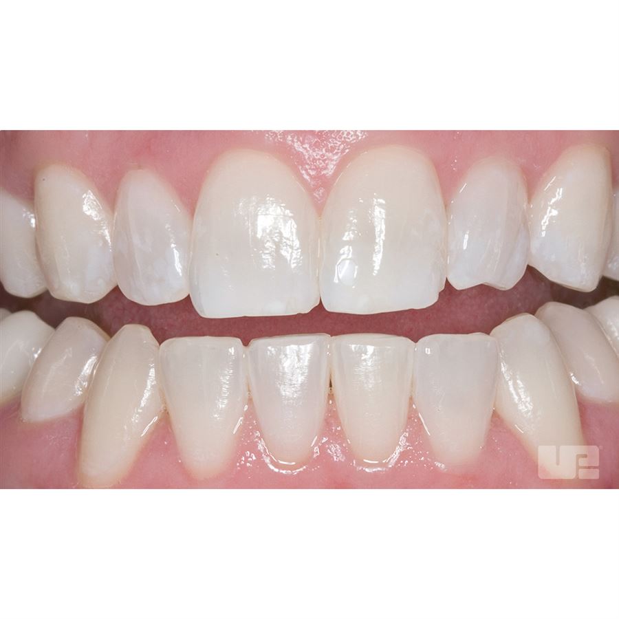 Opalescence Boost PF 40% Intro kit | HUFA