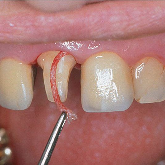 Comprecap Anatomic Set 120 ks | HUFA